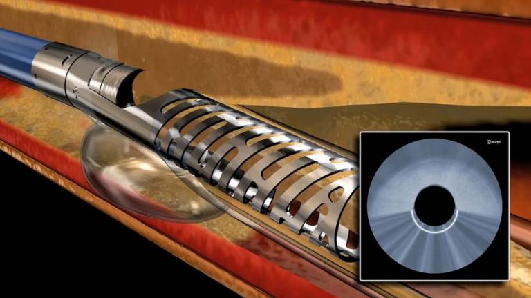 Avinger Receives CE Marking Approval for In-Stent Restenosis Treatment ...