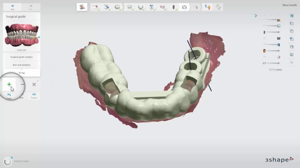 SprintRay 3D Printers Now Supported in 3Shape Implant Studio for ...