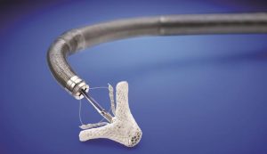 FDA Approves Abbott’s MitraClip for Heart Failure Patients with ...