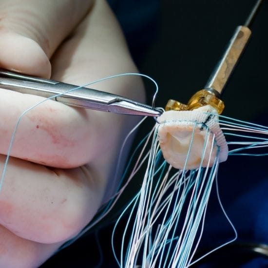 Minimally Invasive Heart Surgery: Can TAVI & TMVr Replace Open Surgery ...